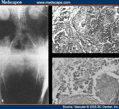 Rare Forms of Peripheral Arterial Embolism: Review of 11 Cases - Page 2