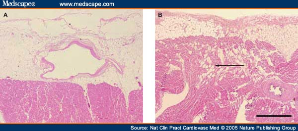 Epicardial Adipose Tissue: Relations to the Heart - Page 2