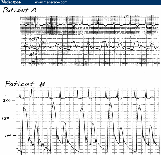 Which Patient Has Pulsus Alternans?