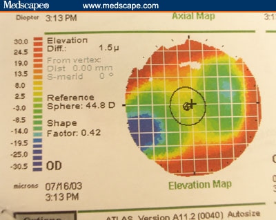 A Case of Posterior Polymorphous Dystrophy? - Page 2