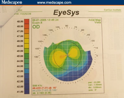 A Case of Posterior Polymorphous Dystrophy? - Page 2