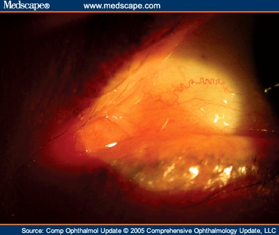 Epiphora Caused by Upper Lacrimal Drainage System Problems - Page 3