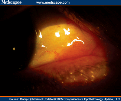 Epiphora Caused by Upper Lacrimal Drainage System Problems - Page 4