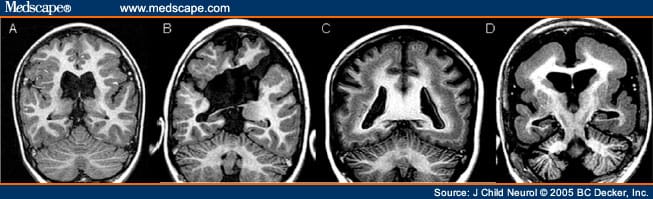 Complications and Malformations of Cortical Development - Page 3