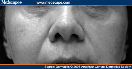 Painful Edema of the Cheek