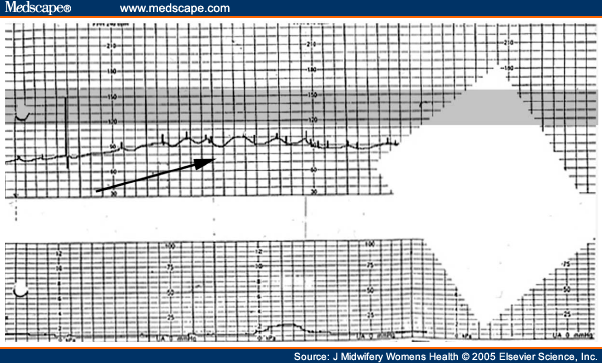 System Errors in Intrapartum Electronic Fetal Monitoring - Page 2