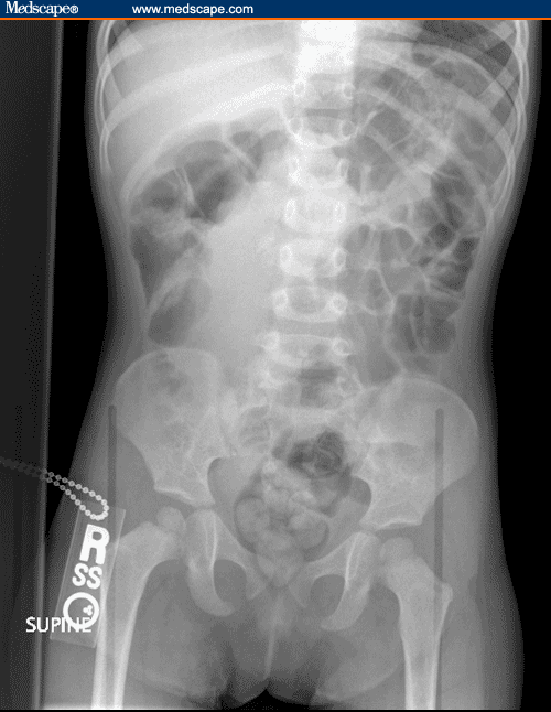 A 2-Year-Old Girl With Chronic and Recurrent Emesis - Page 2