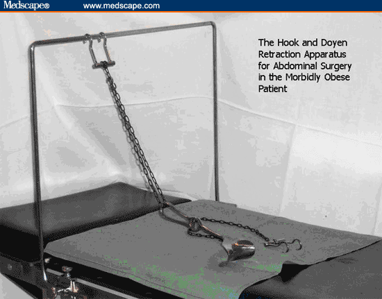 A Simple Apparatus to Retract the Abdominal Panniculus - Page 2