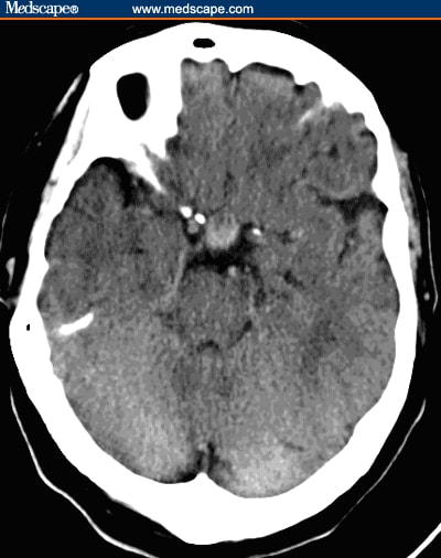 Pituitary Apoplexy - Page 2
