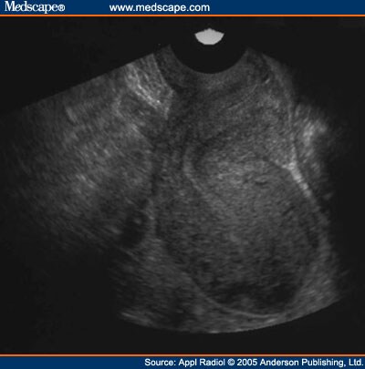 Complete Uterine Perforation