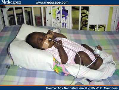 Impacting Infant Head Shapes - Page 4