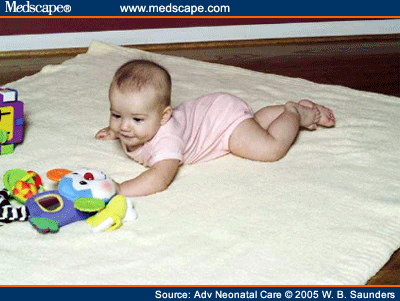 Impacting Infant Head Shapes - Page 5