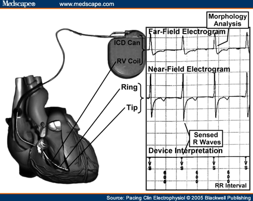 Advanced ICD Troubleshooting: Part I - Page 2