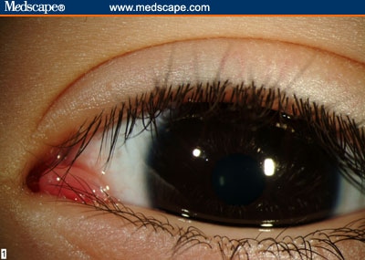 Conjunctival Mass Following Strabismus Surgery
