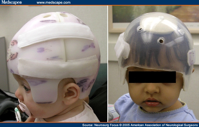 Endoscopic-Assisted Repair of Craniosynostosis