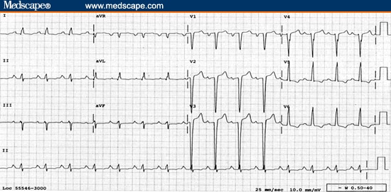 Acute Anteroseptal Infarction?
