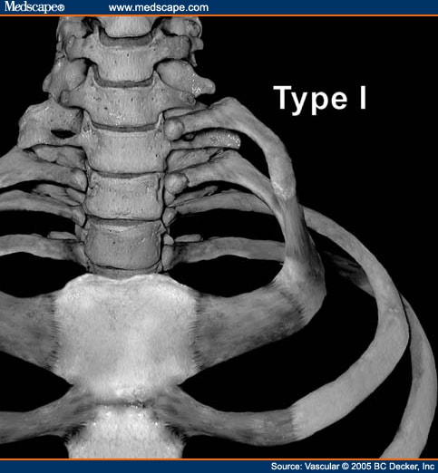 Endoscopic Transaxillary First Rib Resection for Thoracic Outlet