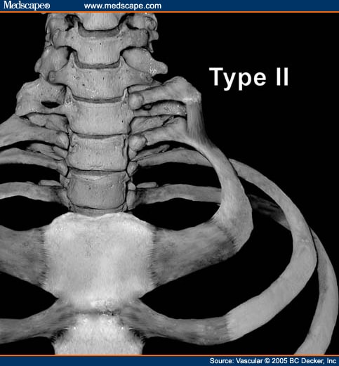 Endoscopic Transaxillary First Rib Resection for Thoracic Outlet