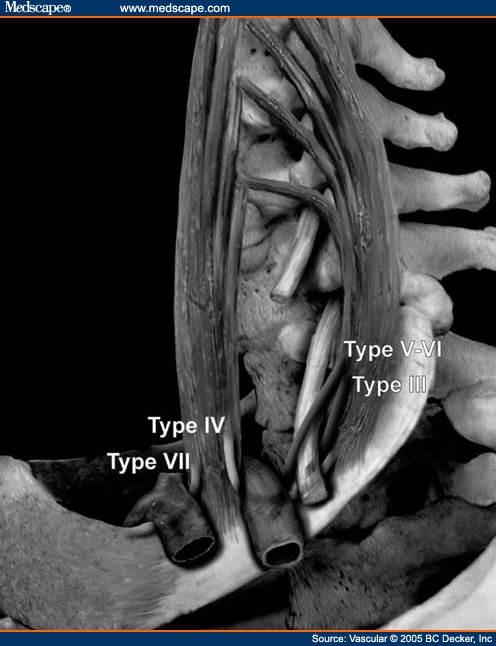 Endoscopic Transaxillary First Rib Resection for Thoracic Outlet