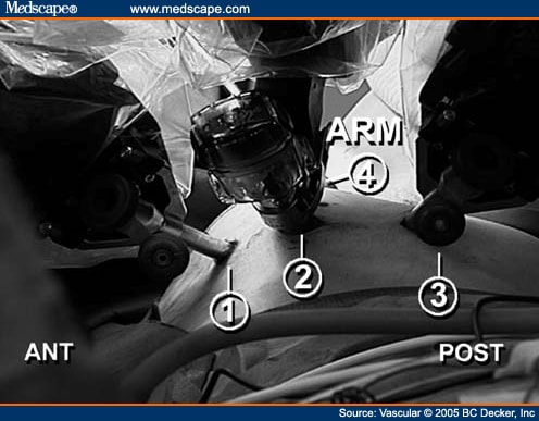 Endoscopic Transaxillary First Rib Resection for Thoracic Outlet - Page 3