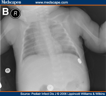 One-Month-Old Infant With Multilobar Round Pneumonias