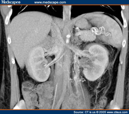 Renal Abnormality