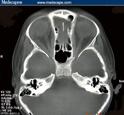 Recurrent Orbital "Cellulitis"