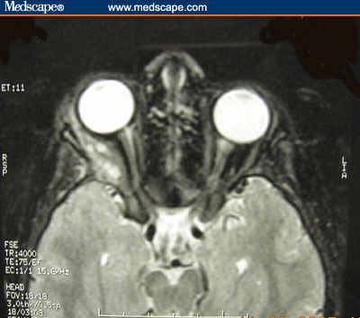 Recurrent Orbital "Cellulitis"