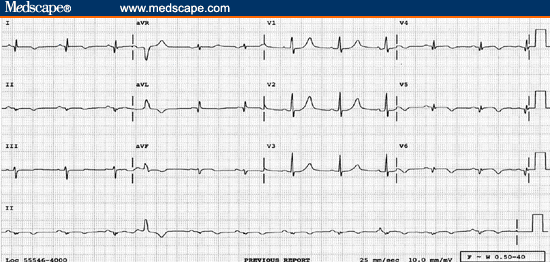 Diagnosis of Tall R Waves in the Right Precordial Leads (I)