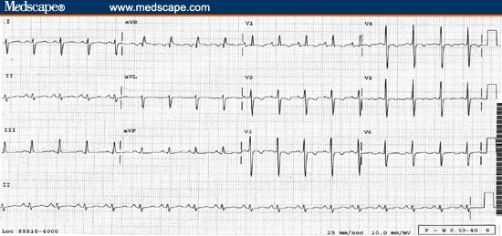 Diagnosis of Tall R Waves in the Right Precordial Leads (II)