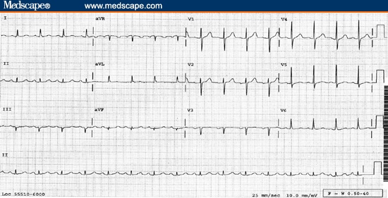 Diagnosis of Tall R Waves in the Right Precordial Leads (III)