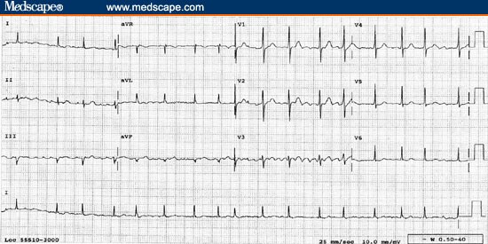 Diagnosis of Tall R Waves in the Right Precordial Leads (IV)