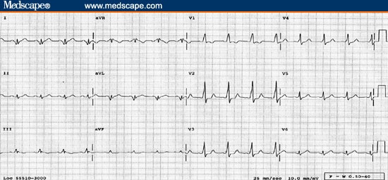 Diagnosis of Tall R Waves in the Right Precordial Leads (V)
