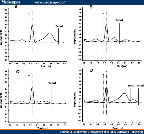 QT Interval: How to Measure It and What Is "Normal"