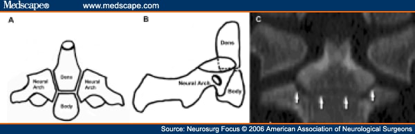 Odontoid Synchondrosis Fractures in Children