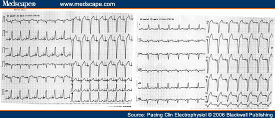 Deleterious Consequences of Right Ventricular Apical Pacing - Page 3