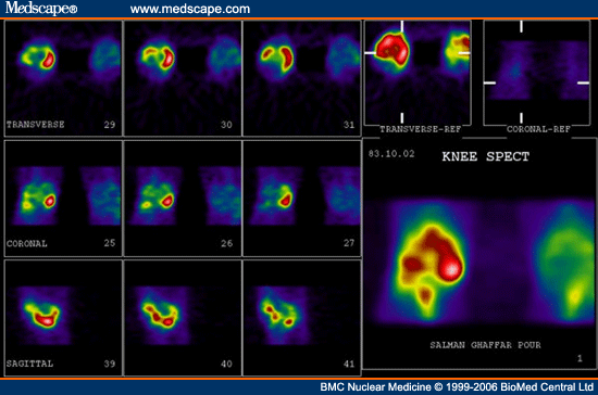 Comparison of SPECT Bone Scintigraphy With MRI - Page 3