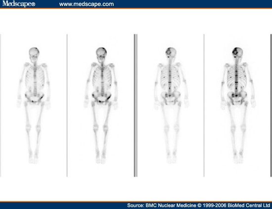 Evaluation of the Clinical Value of Bone Metabolic Parameters - Page 3