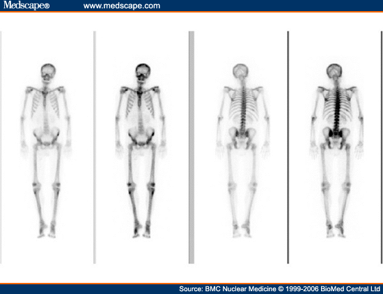 Evaluation of the Clinical Value of Bone Metabolic Parameters - Page 3
