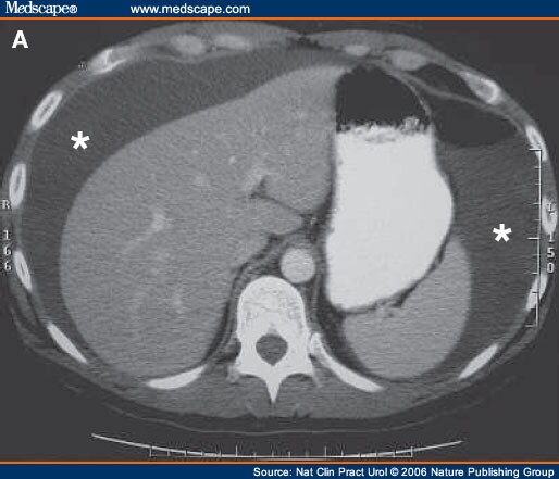 Chylous Ascites Following Retroperitoneal Lymphadenectomy - Page 2