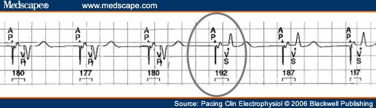 Reducing RV Pacing by Continuous Optimization of the AV Inteval - Page 2