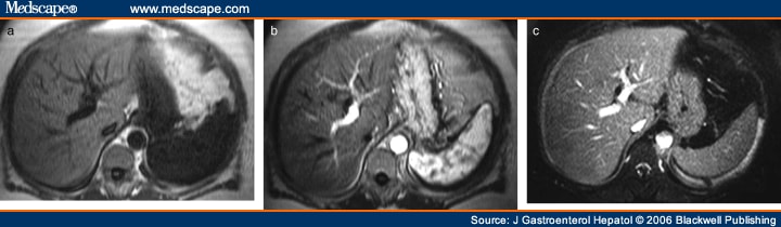 Review -- Magnetic Resonance Imaging of the Liver: How I Do It