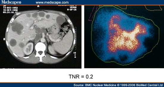 Relationship of 99m Technetium Labelled Macroaggregated Albumin - Page 3