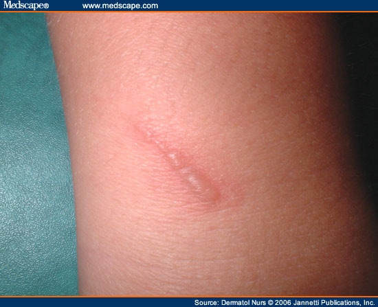 Assessing Phytophotodermatitis