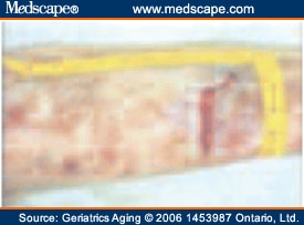 Pressure Ulcers and Skin Tears in Older Adults - Page 2