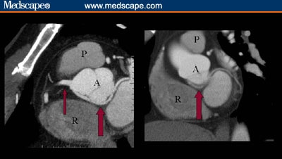Cardiac CTA: One-Stop-Shop Coronary Artery Assessment