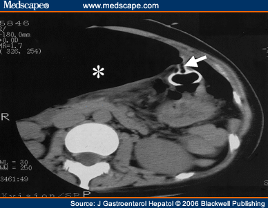 Pneumoperitoneum 3 Weeks After PEG - Page 2