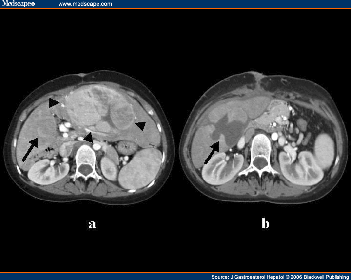 Combined Hepatic Resection And Radiofrequency Ablation For Hepatic