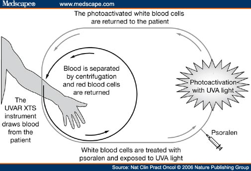 Technology Insight: ECP for the treatment of GvHD - Page 2