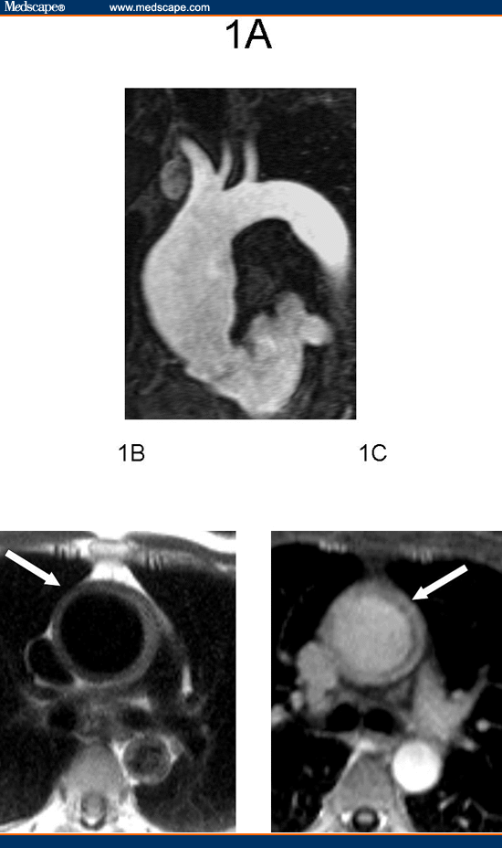 Advances in Imaging: Thoracic MRI/MRA: State-of-the-Art and Science